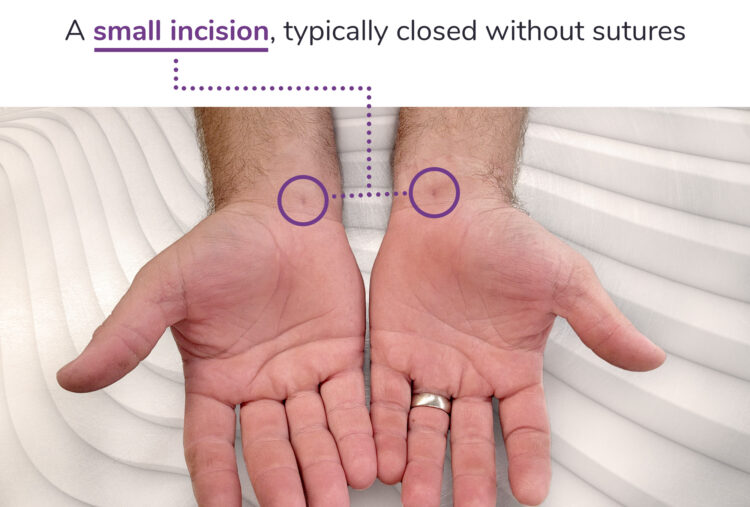 Carpal Tunnel Syndrome - Sonex Health